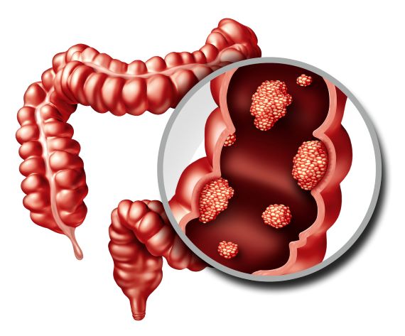 The Difference Between Colon Polyps And Colon Cancer